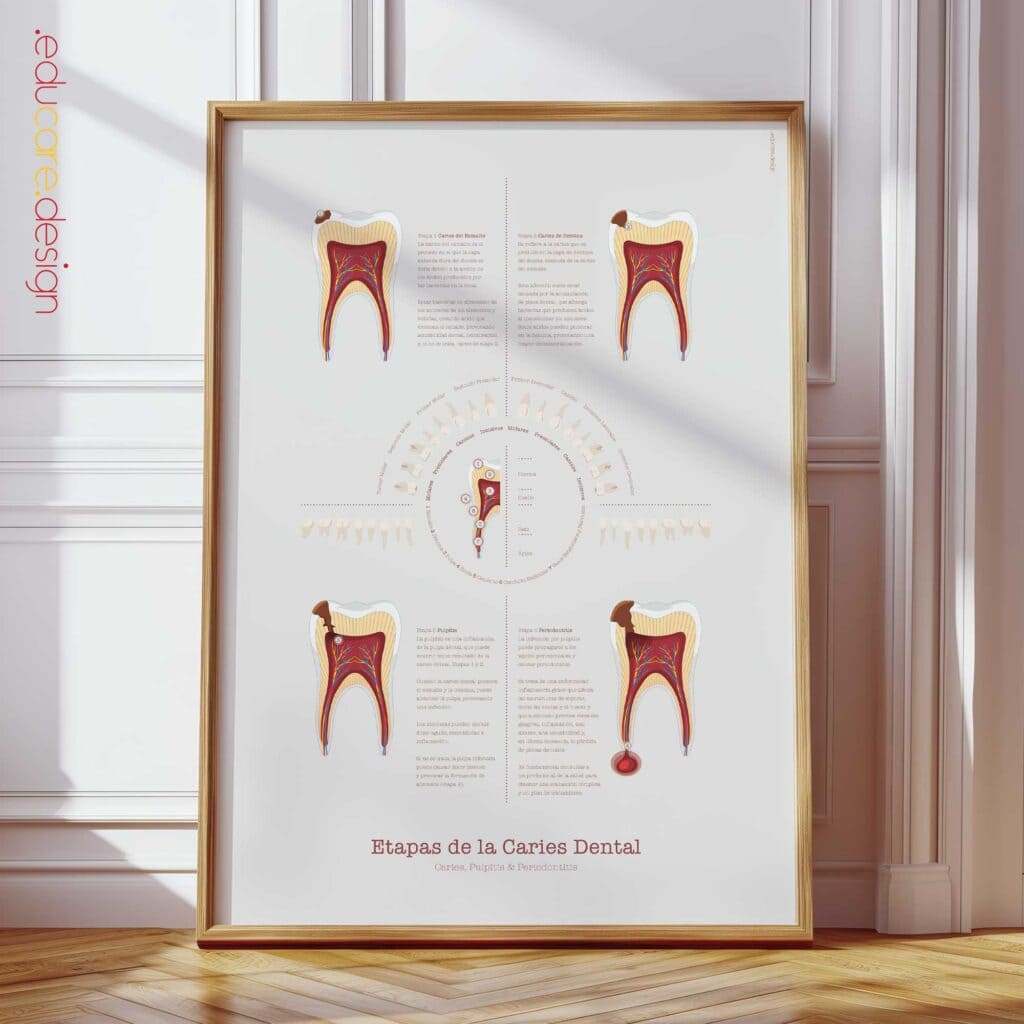 Stages of Tooth Decay » educare.design