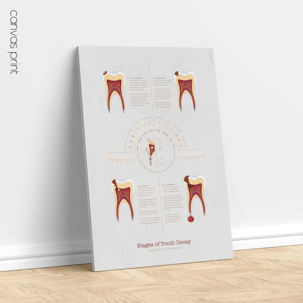 Stages of Tooth Decay » educare.design