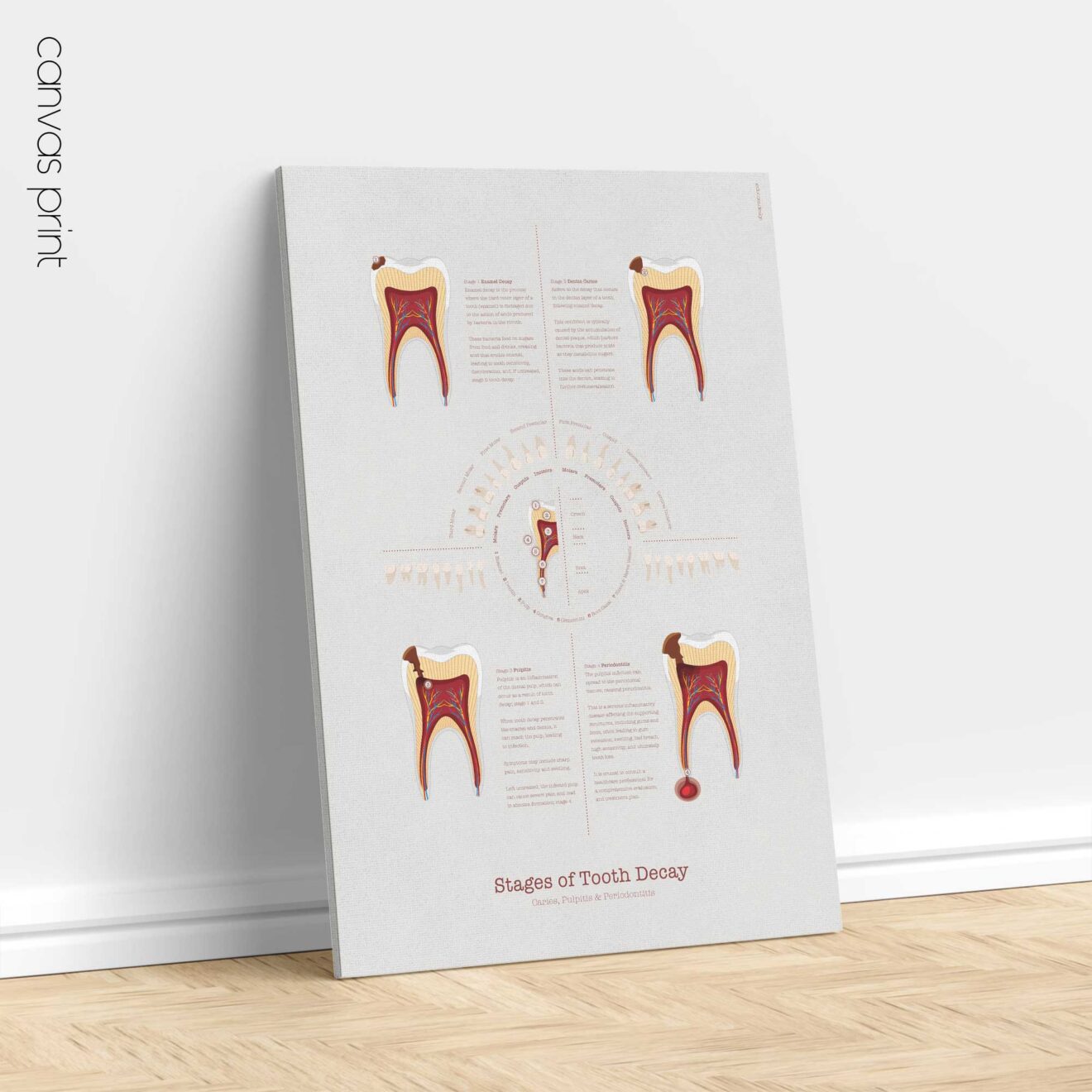 Stages of Tooth Decay » educare.design