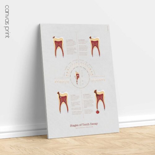 Stages of Tooth Decay » educare.design