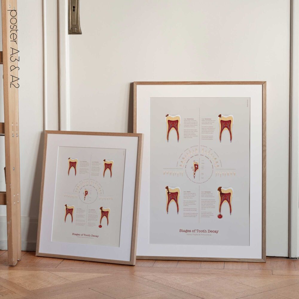 Stages of Tooth Decay » educare.design